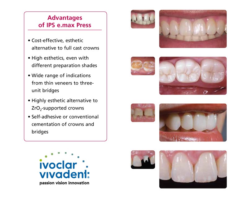 Emax - Mabel Dental Lab