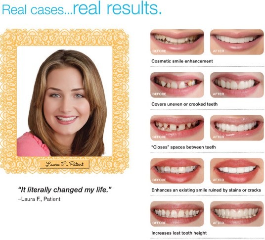 Snap-On Smile® - Mabel Dental Lab